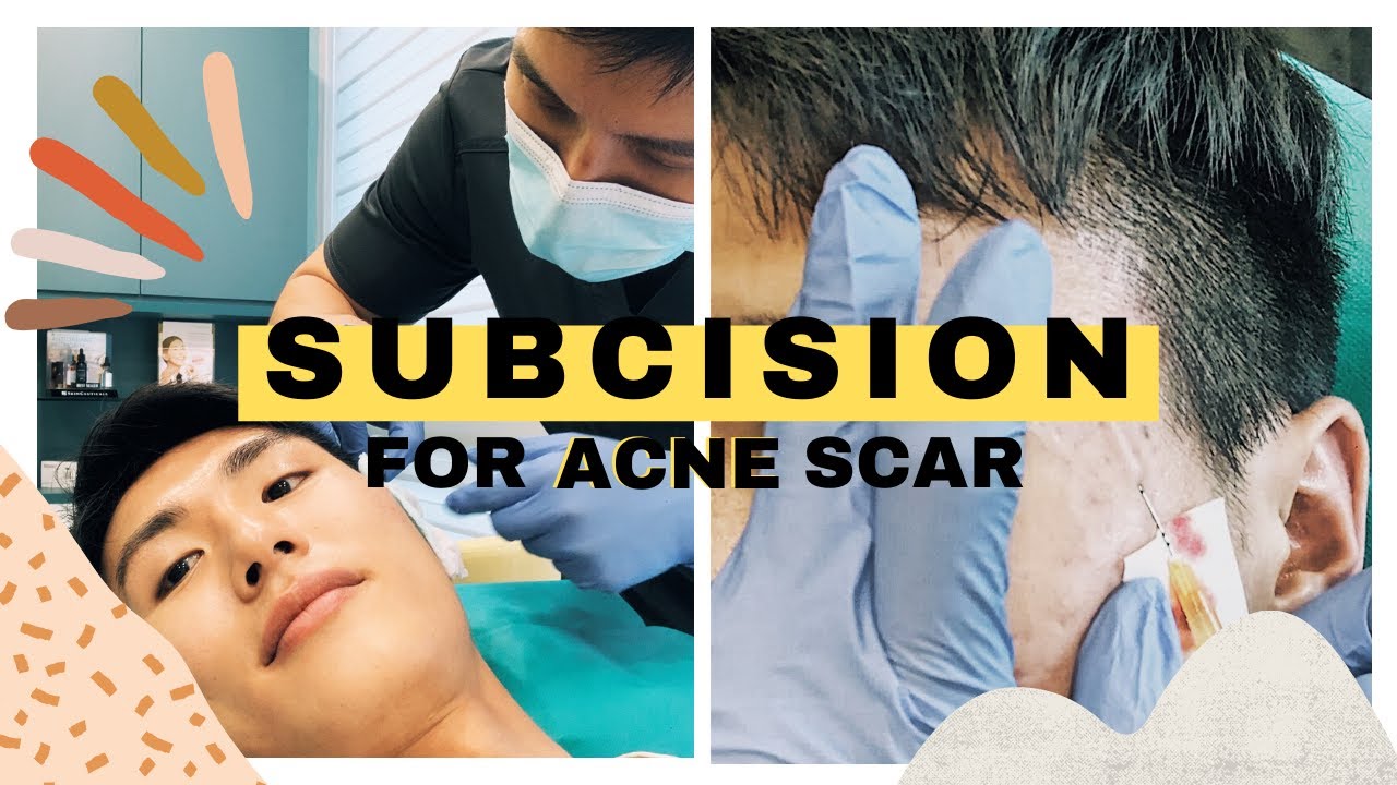 Subcision for Acne Scar | The Most Effective Scar Treatment - YouTube