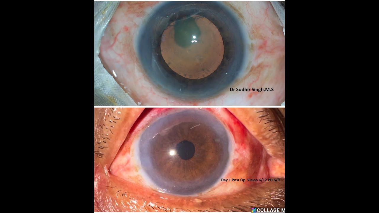 SICS In Posterior Polar Cataract (Unedited) HD - YouTube