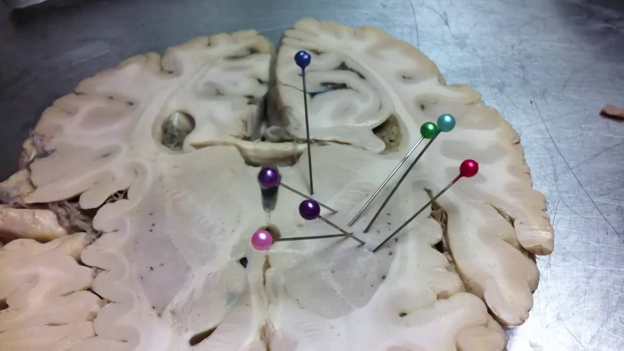 Monitoria de Neuroanatomia - Núcleos da Base 1 - YouTube