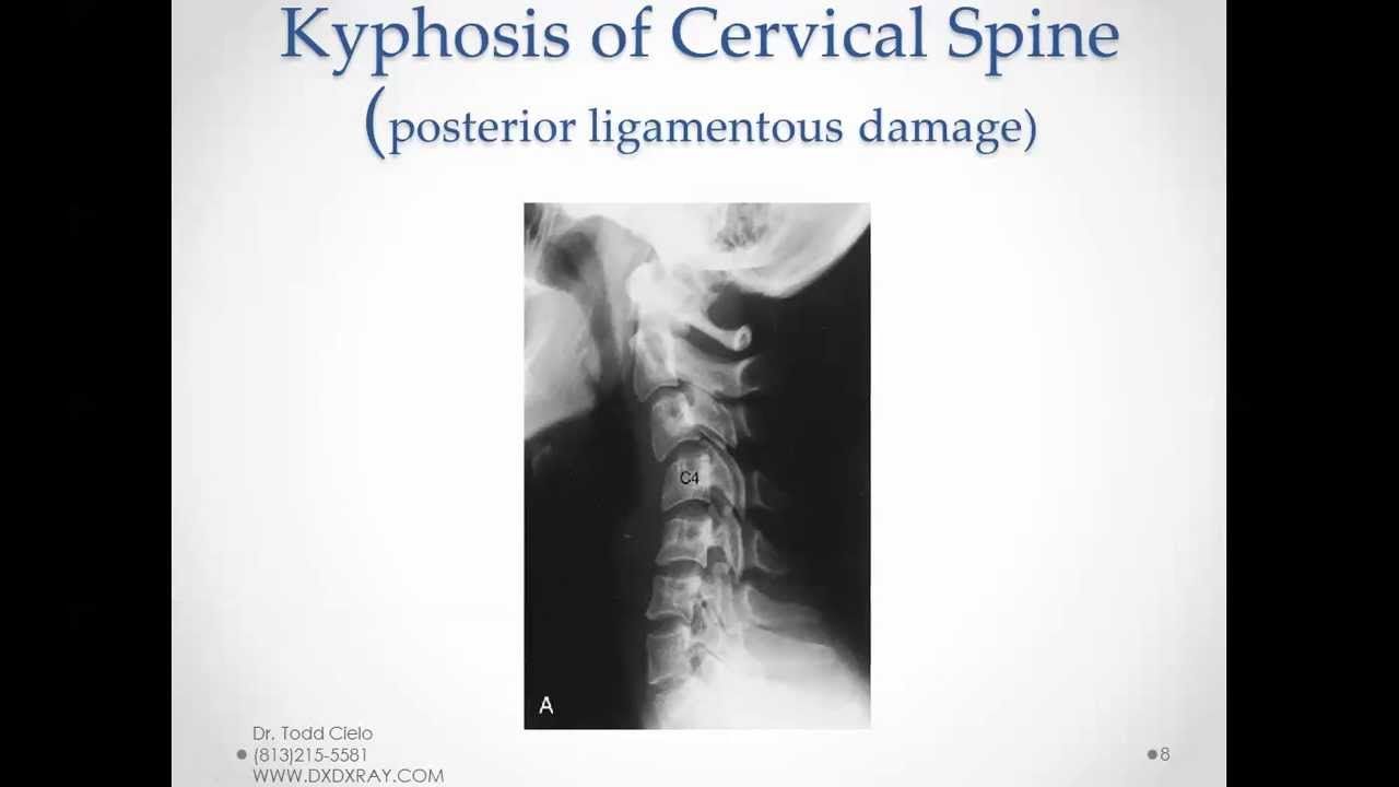 DXD Software Ligament Laxity Analysis Webinar - YouTube