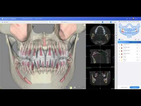 DeepCare's Pulp Segmentation and Brand-New 3D Interaction - YouTube