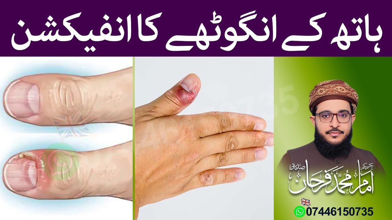 Hath Ke Anghotay Ka Infection | ہاتھ کے انگوٹھے کا انفیکشن | Infection ...