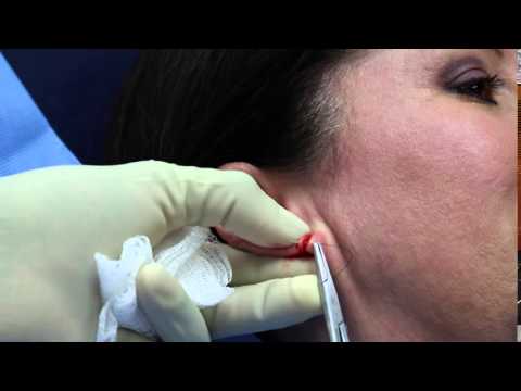 How To Repair Earring Hole