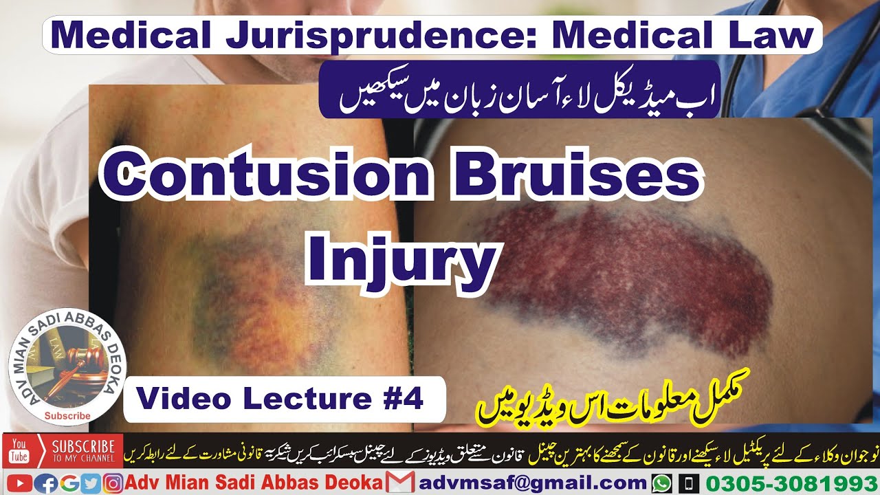 Contusion Bruise Injury | Contusion Bruises Wound | Medical ...