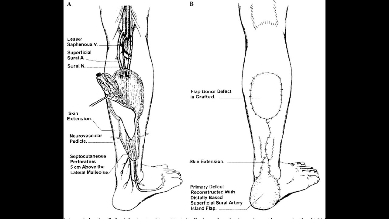 Reverse Sural Flap (Vạt da sural) - YouTube
