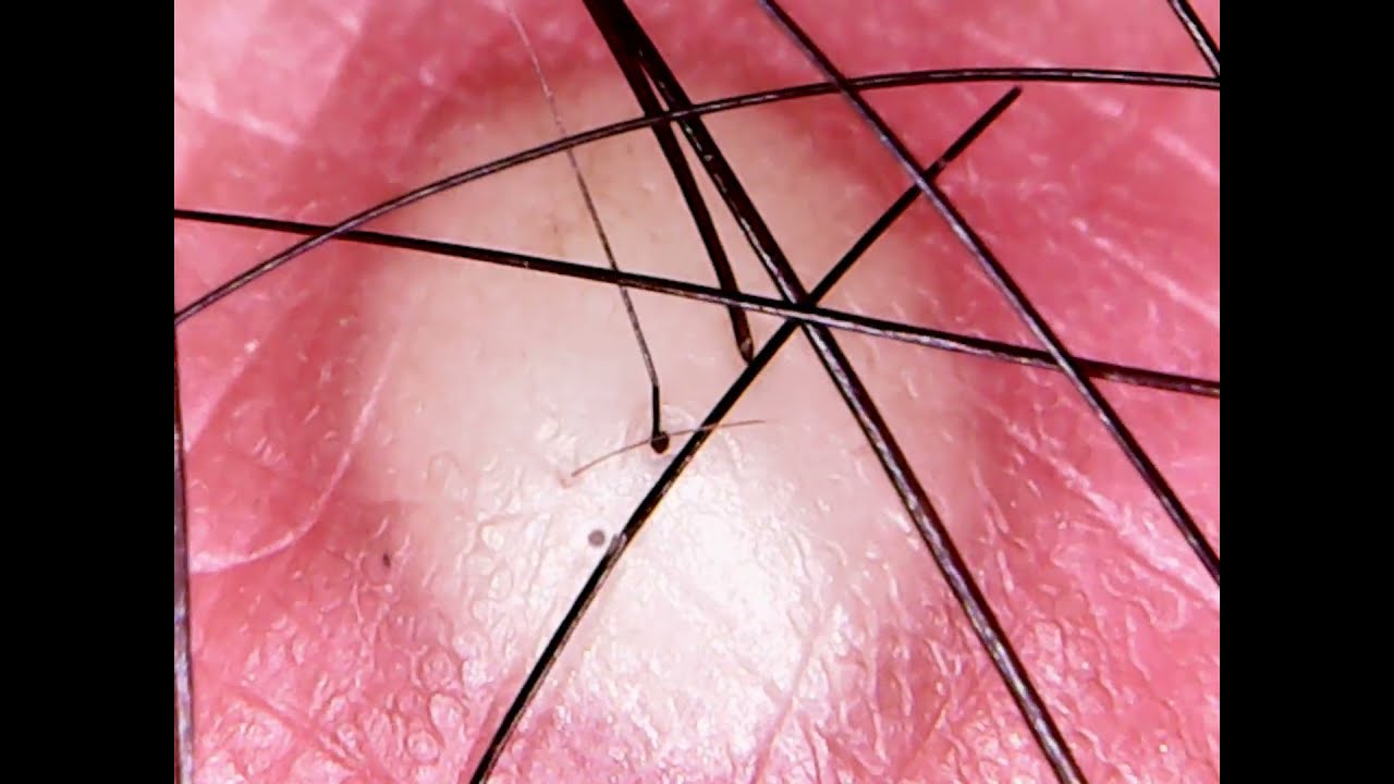 Hair Plucking From Pus - YouTube