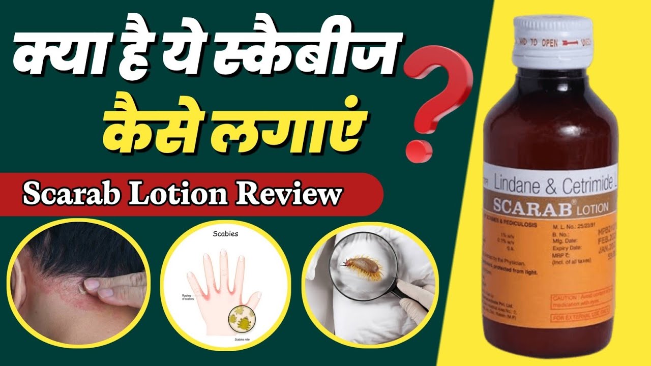 Scarab Lotion Kaise Lagaye | Lindane And Cetrimide Lotion | Scabies Aur ...
