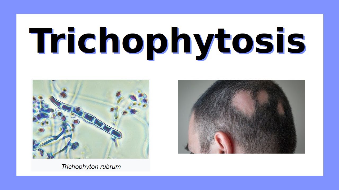 trichophytosis - YouTube
