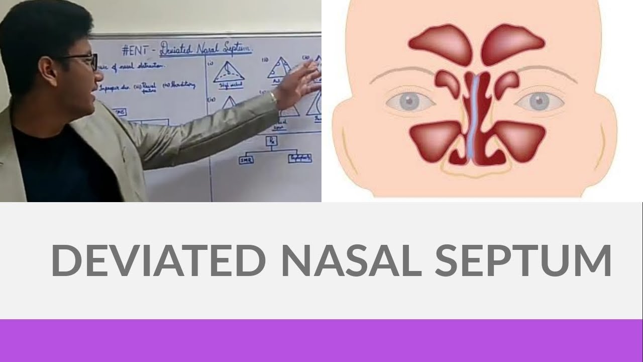 DEVIATED NASAL SEPTUM | The White Army - YouTube