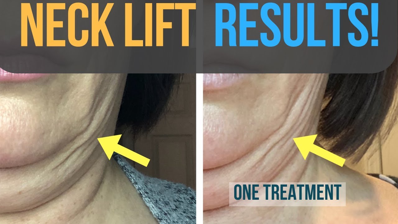 Results From My Fibroblast Plasma Neck Lift - YouTube