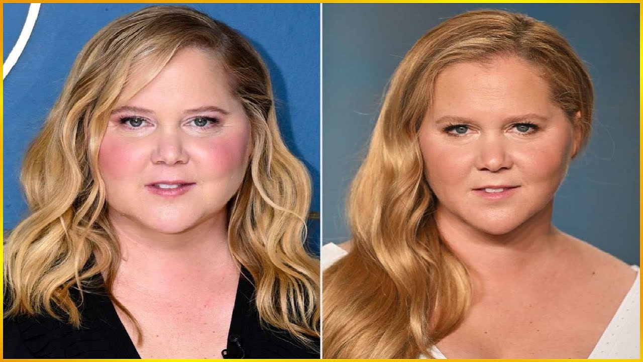 🔴Amy Schumer Says Comments About Her 'Moon Face' Led to Cushing ...
