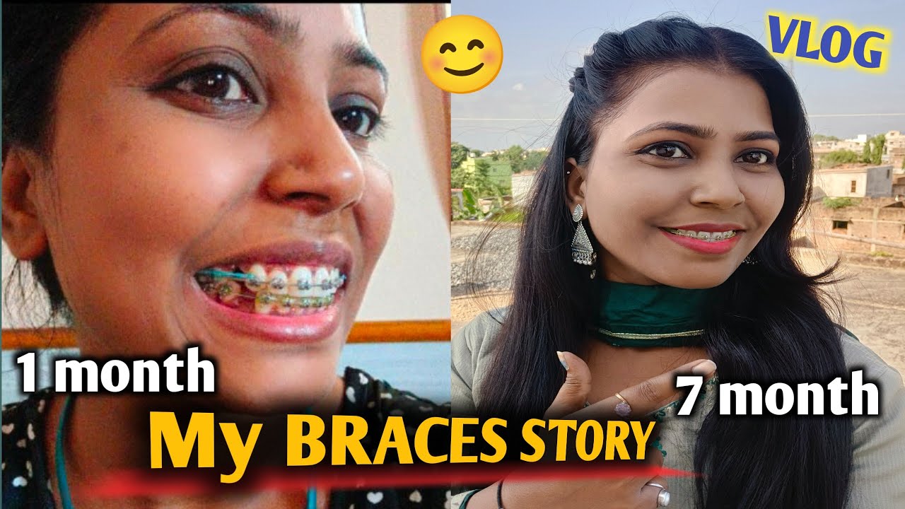 My Braces Journey|| My Braces Story 😊 ND Family Vlogs - YouTube