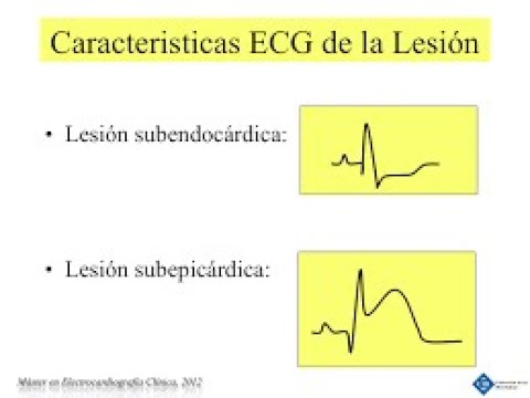 Isquemia, lesión e infarto - YouTube