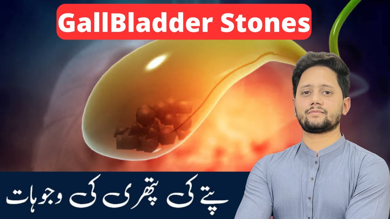 Gallbladder Stones Causes - Pity Ki Pathri Kyu Hoti Hai in Urdu - Dr ...