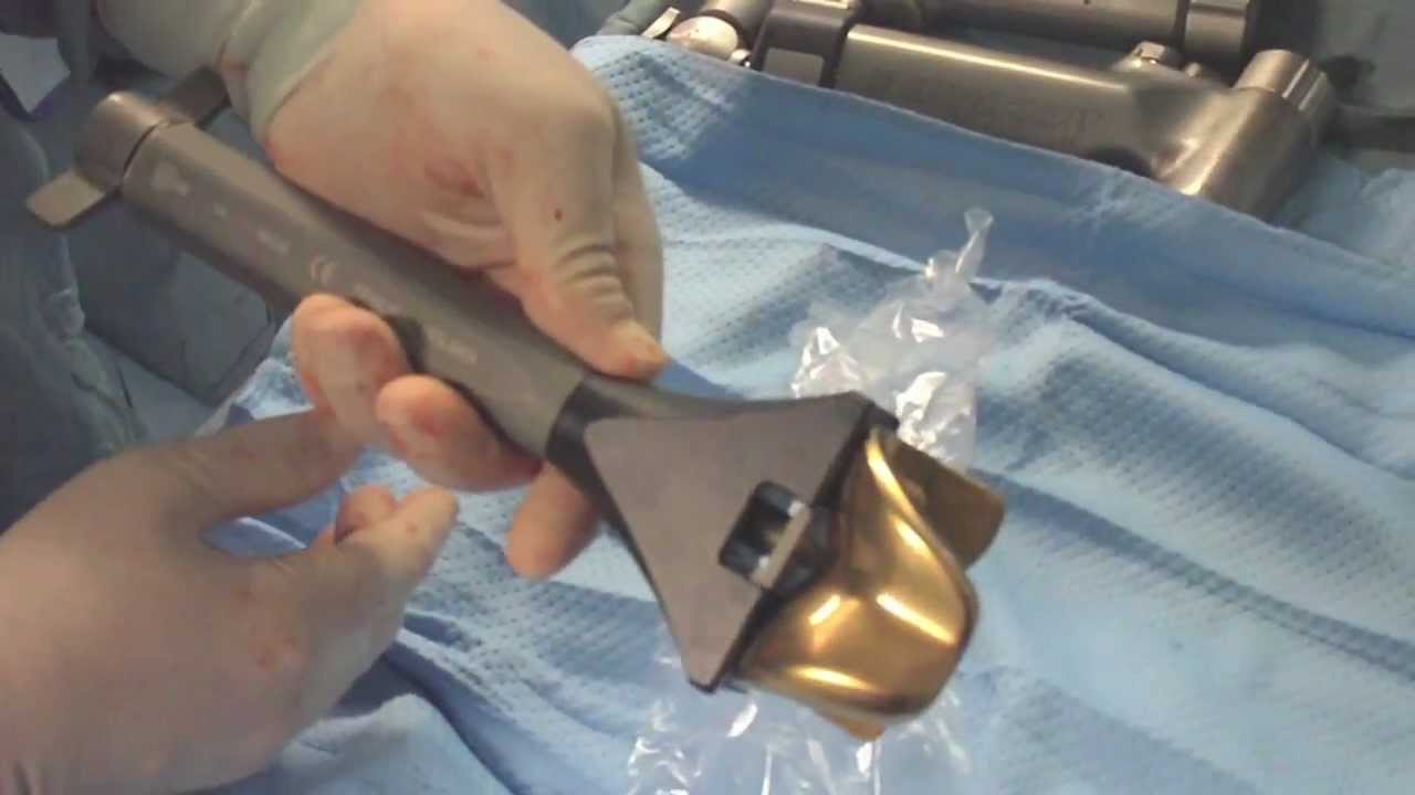 Total knee replacement uncemented :BP knee prosthesis and lateral ...