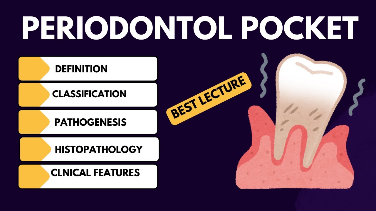 Periodontal Pocket | Periodontal Pocket Formation Periodontology ...