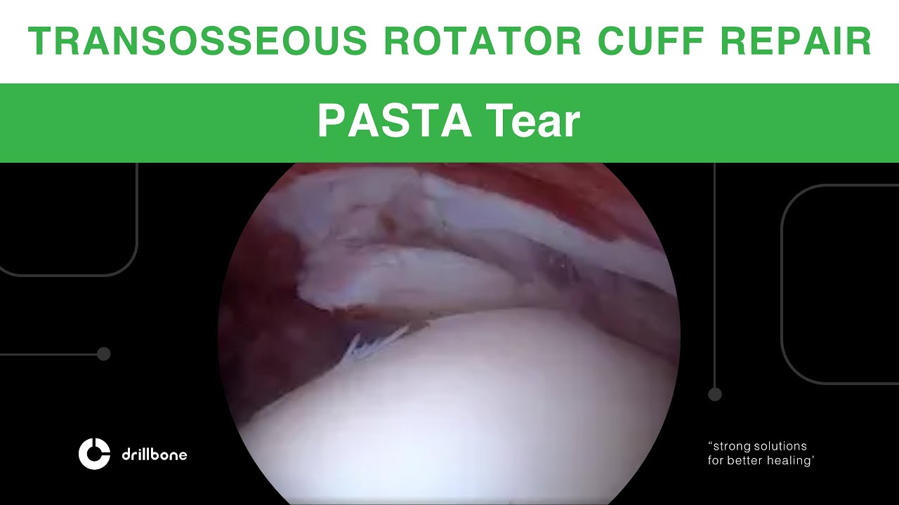 Transosseous Rotator Cuff Repair [PASTA TEAR] - YouTube