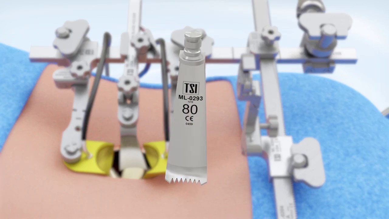 Phantom ML MIS Lumbar Surgical Access System (ML-2000) - YouTube
