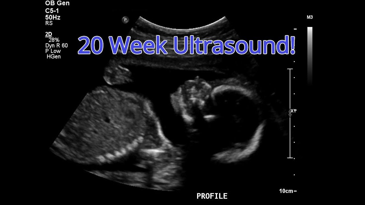 20 Weeks Ultrasound