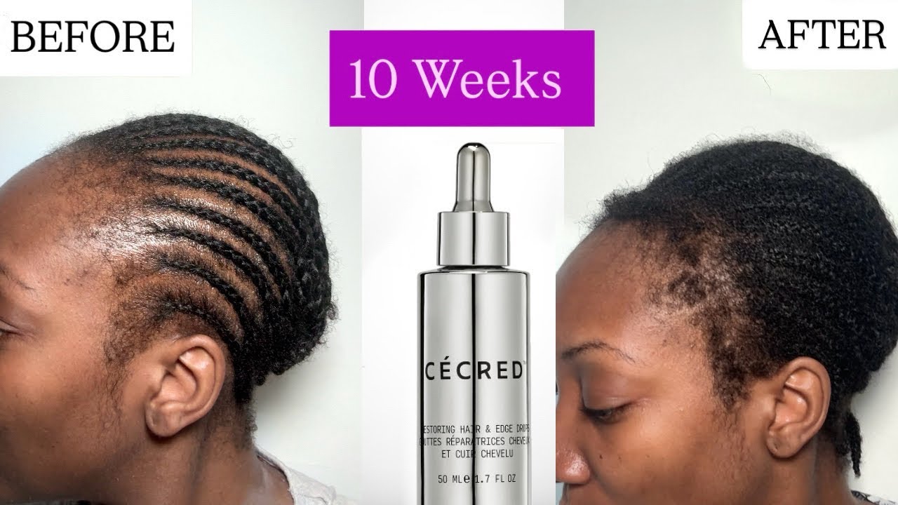 Cécred Restoring Hair & Edge Drops Review Before & After 10 Weeks - YouTube