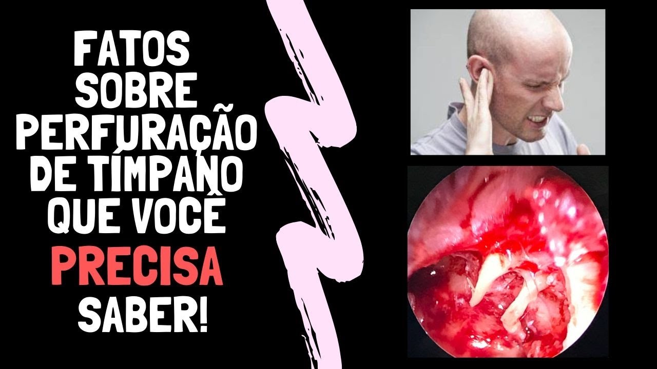 TUDO sobre PERFURAÇÃO DE TÍMPANO! Vou ficar SURDO? O tímpano REGENERA ...
