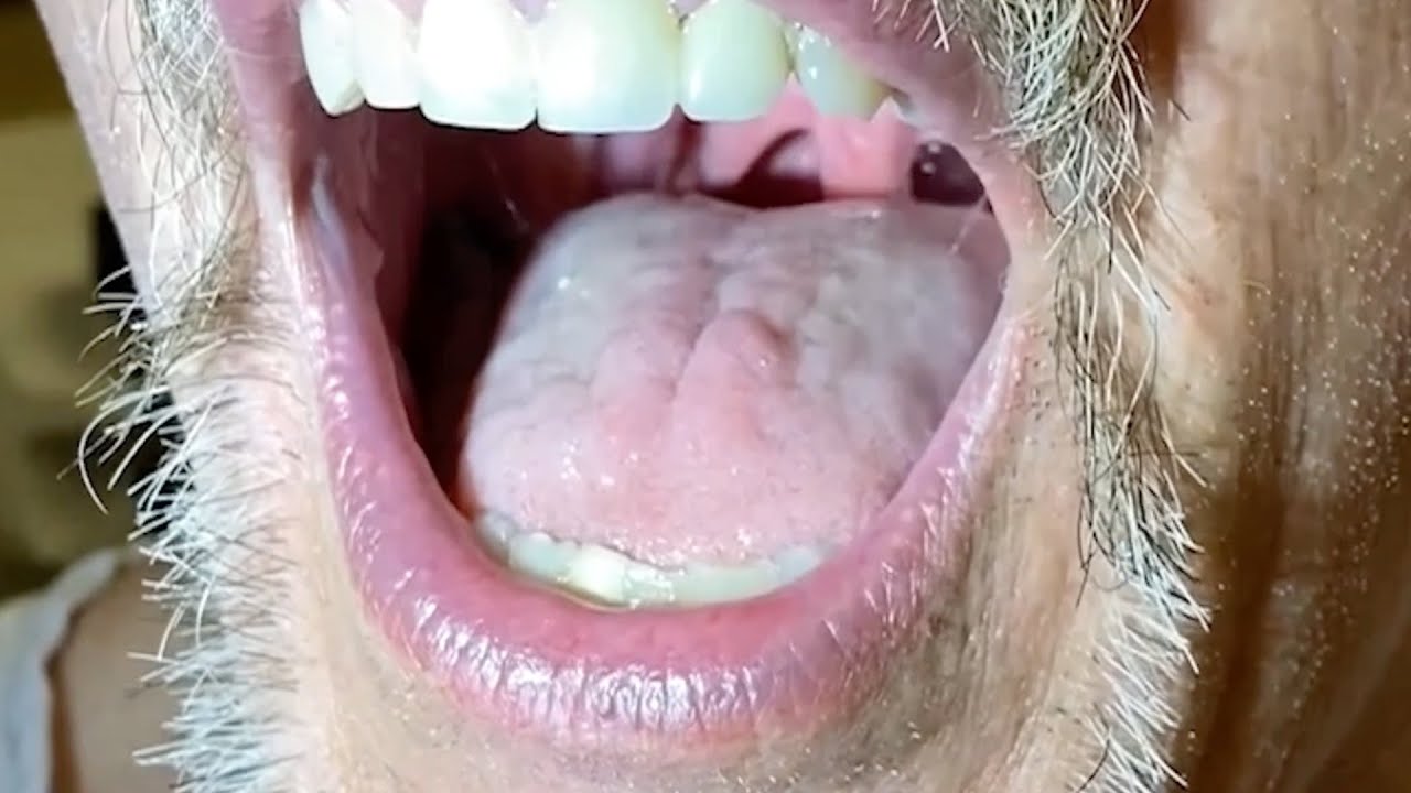 Rhythmic Tongue Contractions and Left Mentalis Myokymic Bursts in ...