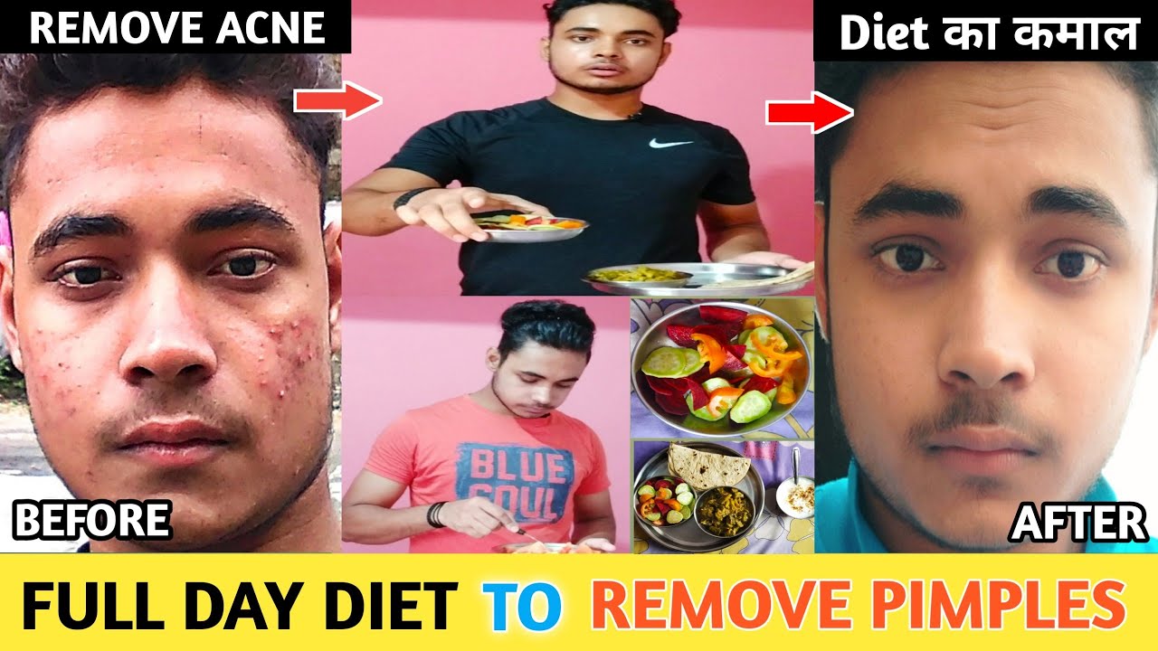 Full Day Diet To Remove Acne & Pimples | Natural Acne Treatment |Food ...