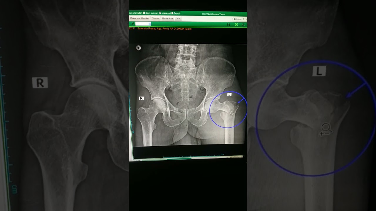 pelvis Ap, Hip joint, PBH-AP X-ray - YouTube