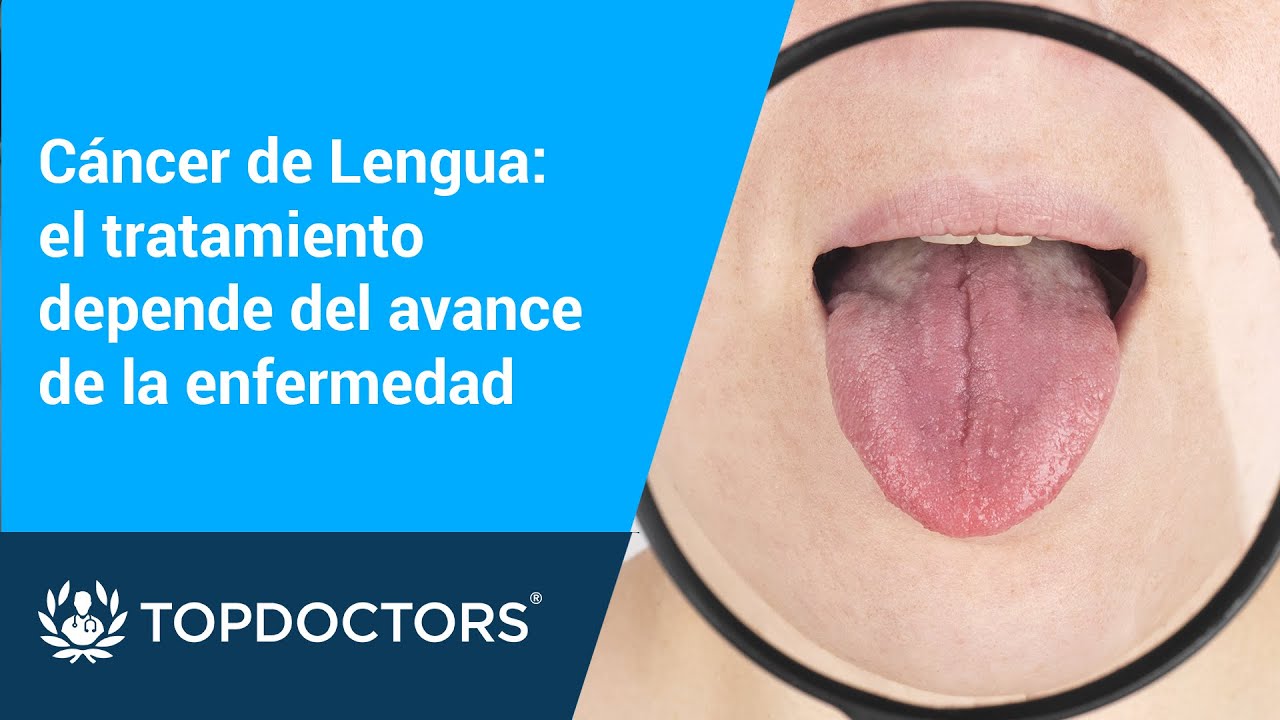 Cáncer de Lengua: el tratamiento depende del avance de la enfermedad ...