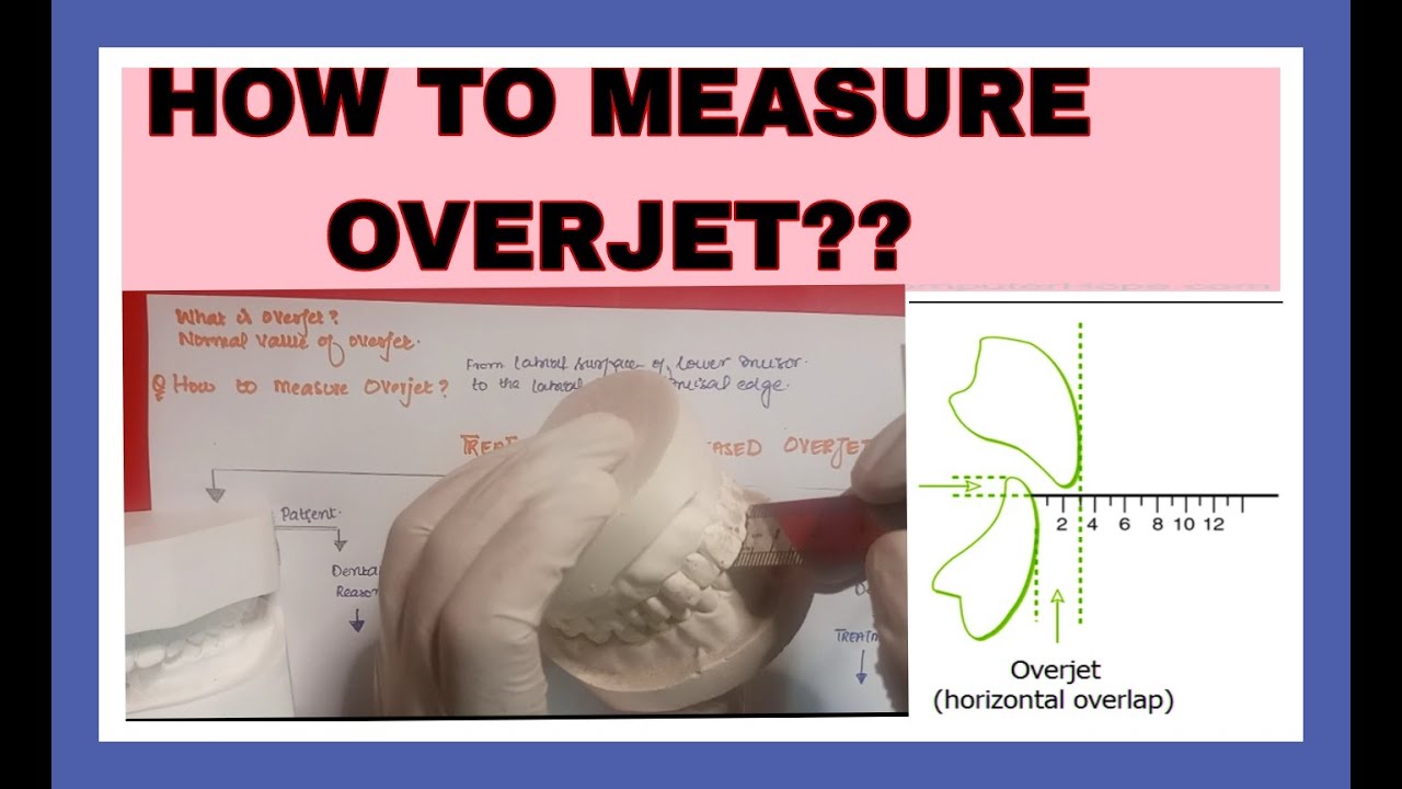How to measure overjet??proffit chapter 1 - YouTube