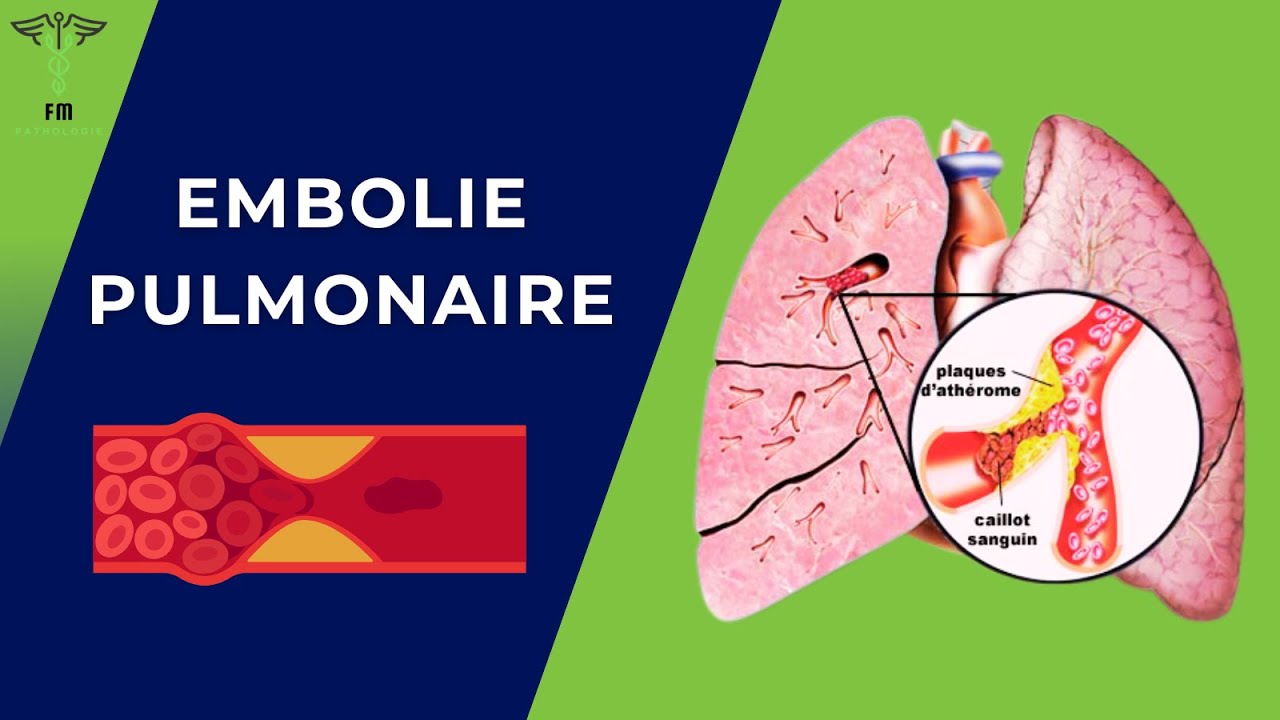 Embolie Pulmonaire Aigue (Facteurs de Risques / Signes Cliniques ...