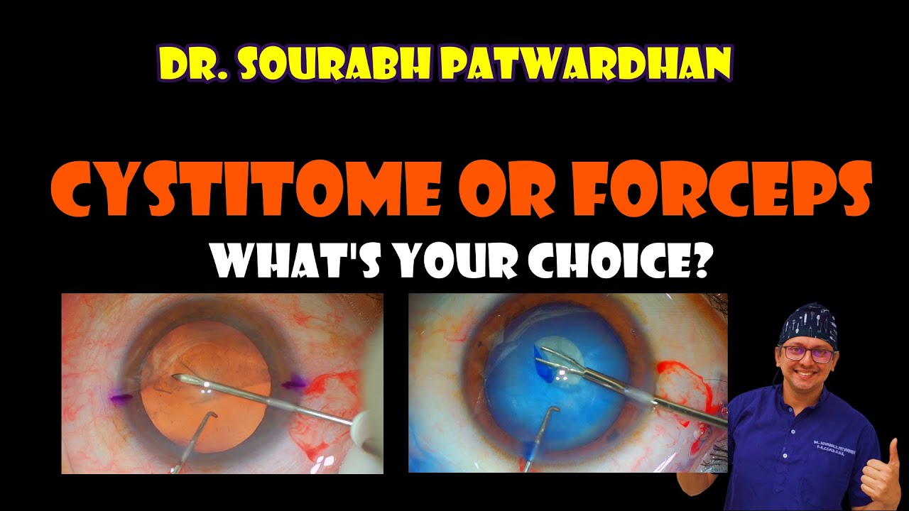 129 Cystitome or forceps for CCC..which one Dr Sourabh Patwardhan - YouTube