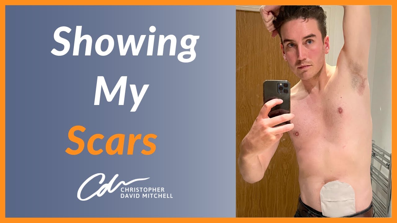 I Show My Scars from IBD Surgery (Never Seen Before!) - YouTube