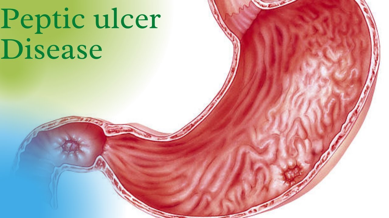 Peptic ulcer disease - causes, clinical features, investigation ...