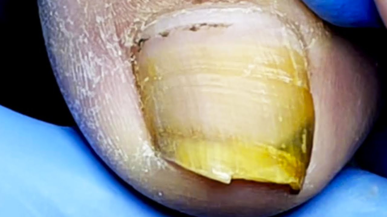 Yellow toenails, easy to trim ingrown toenails - YouTube