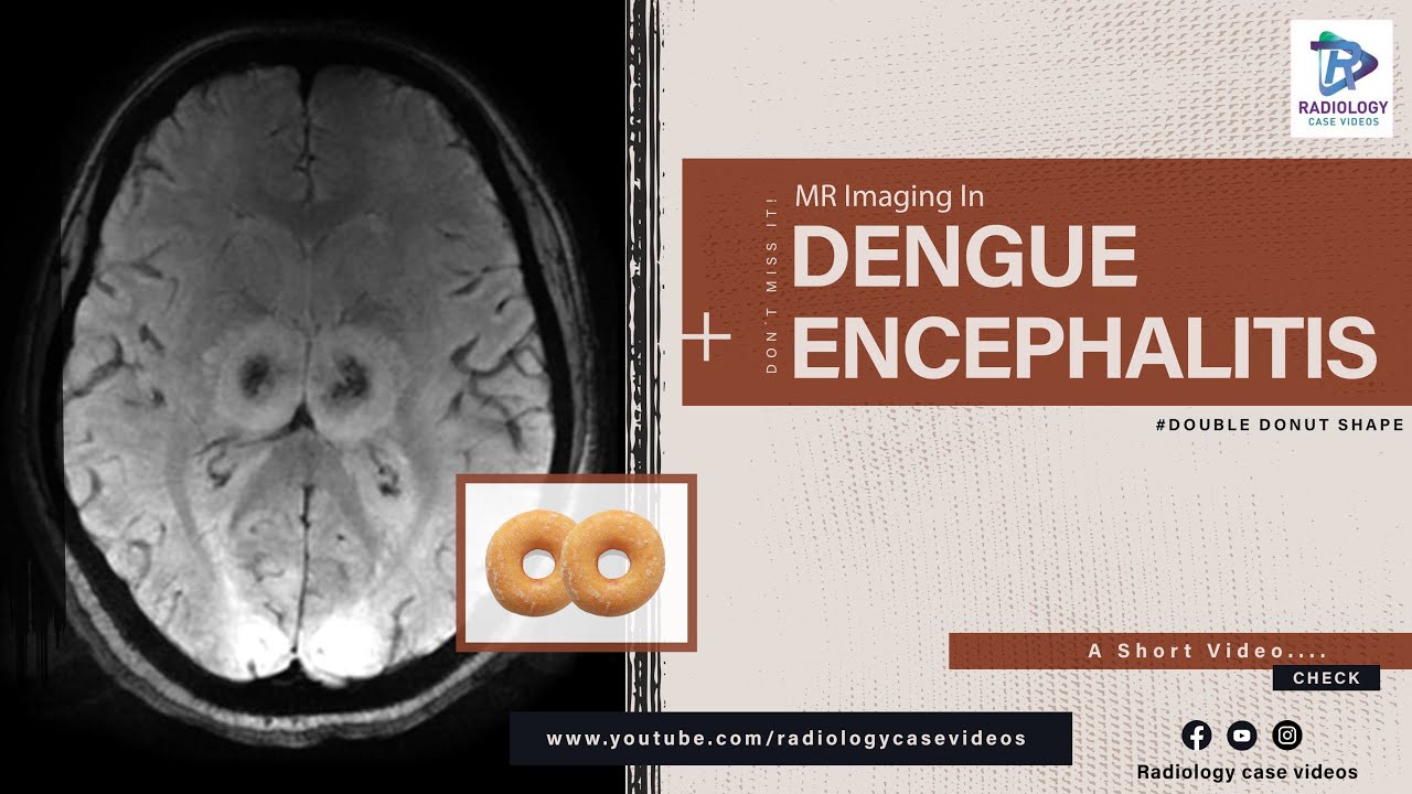 MR Imaging in Dengue Encephalitis#Double doughnut sign#Umamaheshwara ...