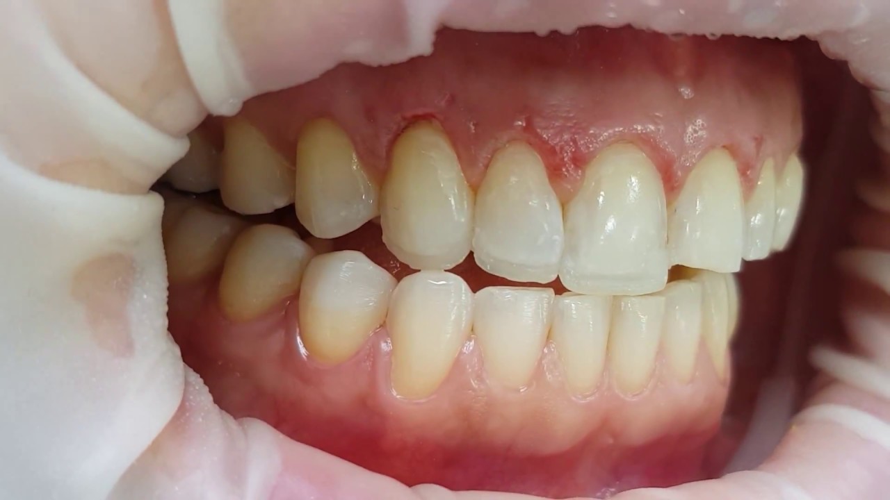 Ajuste oclusal - Amparo Aguirre Atenas Smile Experts - YouTube