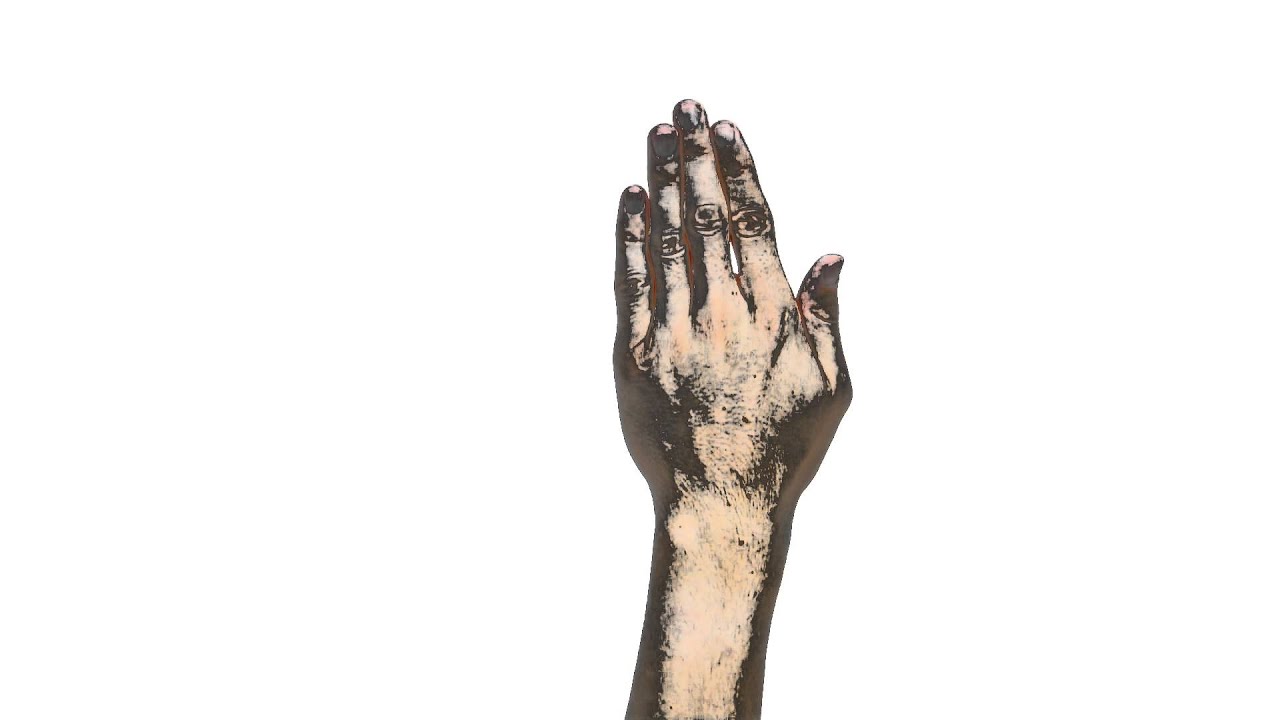 WRIST RADIAL DEVIATION -hep2go - YouTube