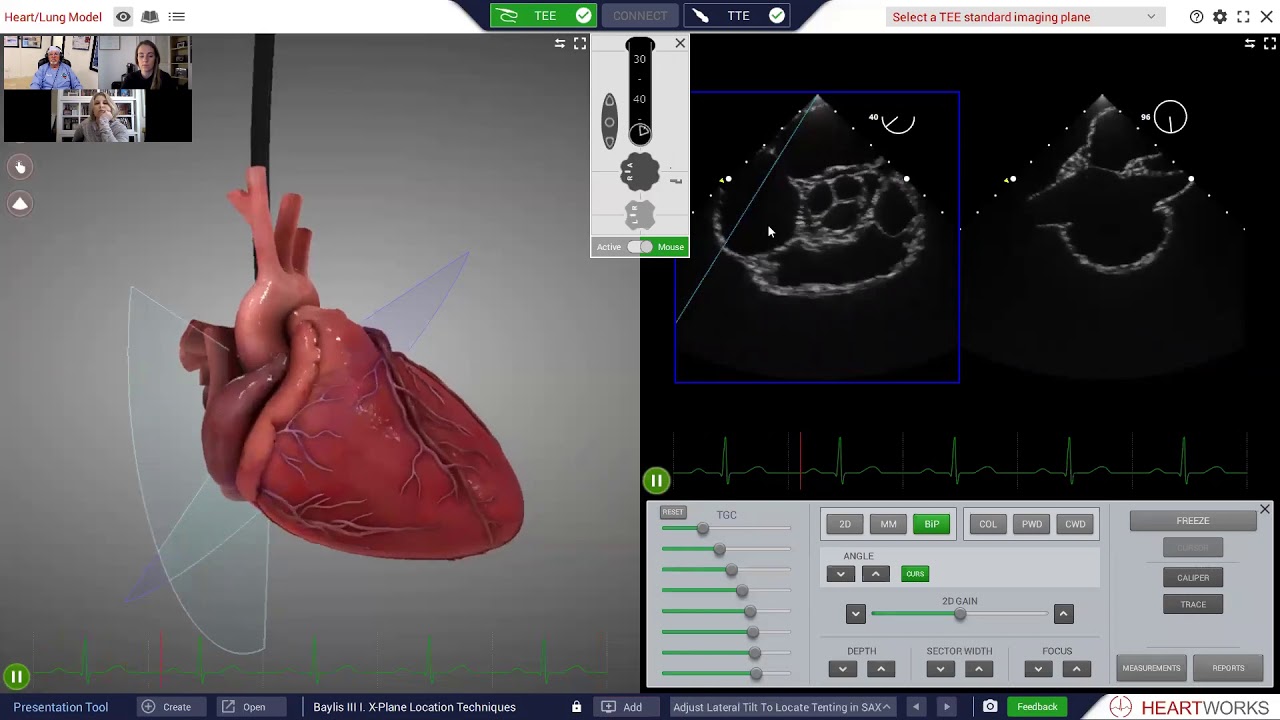 TEE Transeptal Online Training - YouTube