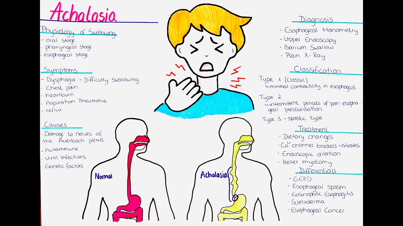 Understanding Achalasia - Causes, Symptoms, Diagnosis, Classification ...