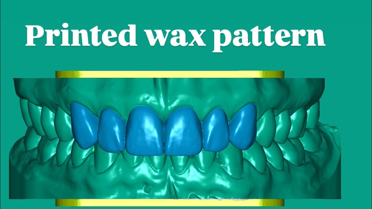 Crown and bridge /printed wax pattern - YouTube