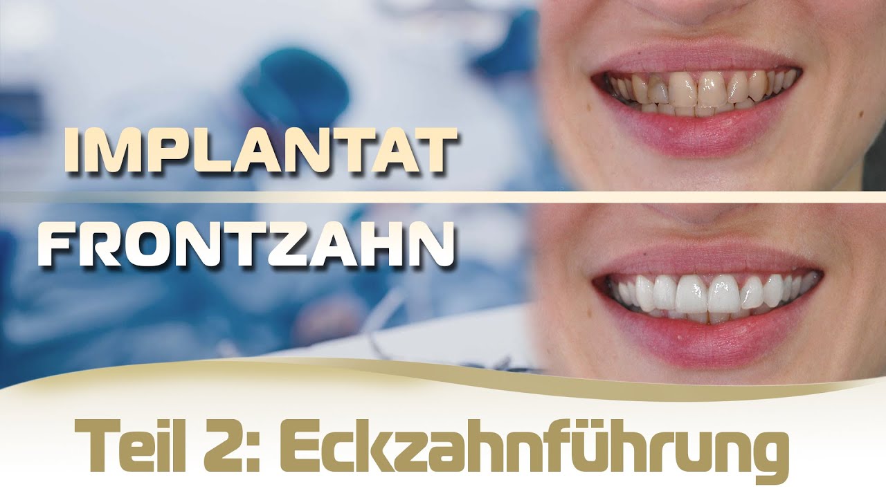 Implantat einsetzen Frontzahn Ablauf: Teil 2 - Eckzahnführung und ...