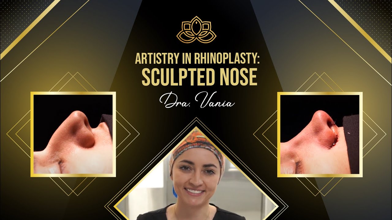 Sculpted Nose🤩Amazing Rhinoplasty👃 by Dr Vania in #tijuana 💖-Vive ...