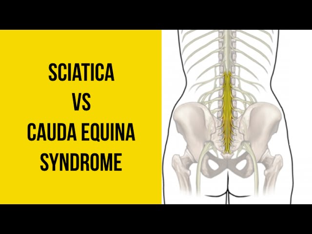 Sciatica Vs Cauda Equina Syndrome Medical Emergency