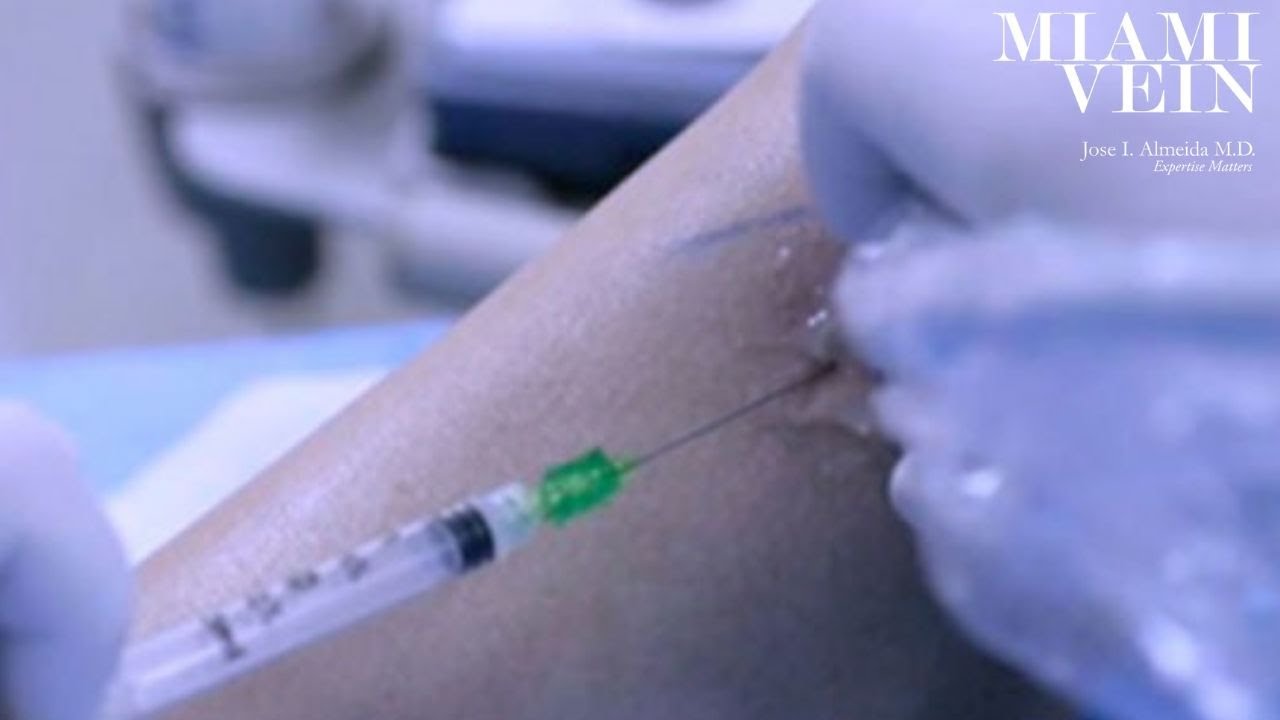 Sclerotherapy Treatment Preparations at the Miami Vein Center - YouTube