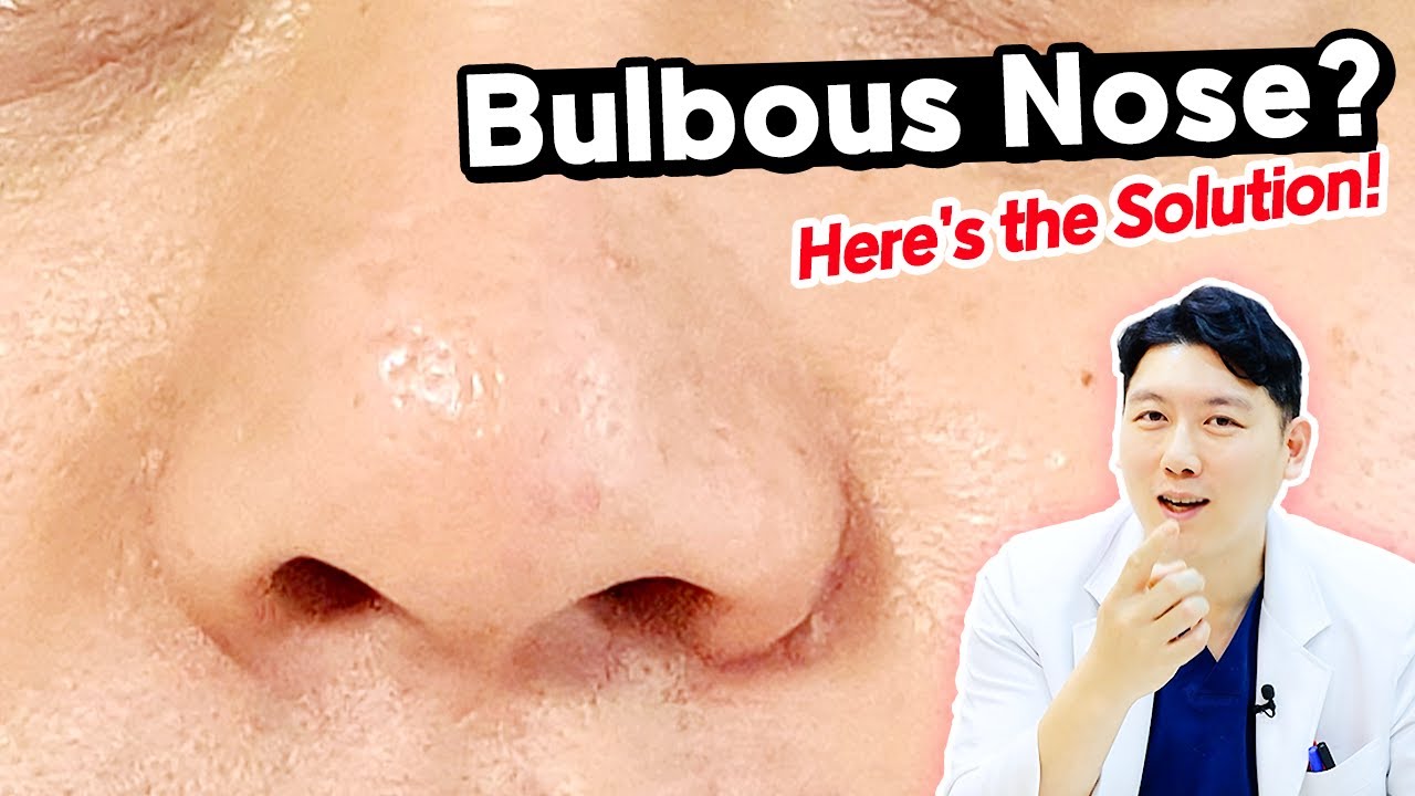 Bulbous Nose Surgery – Tip Correction Determines Results! - YouTube