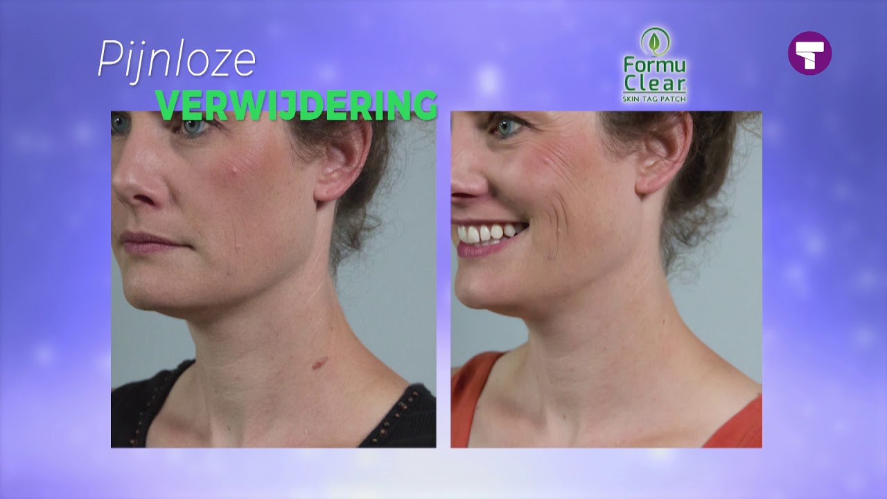 Formuclear Skin Tag Patch | Tommy Teleshopping - YouTube