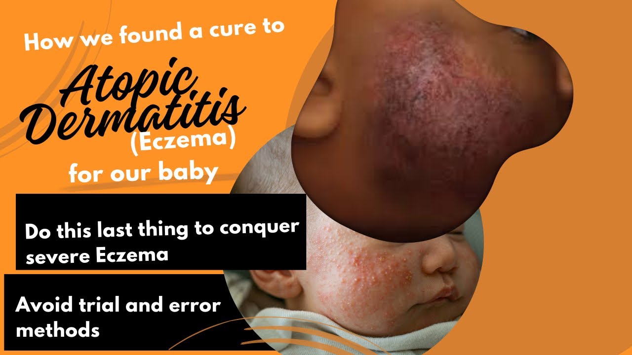 How to treat Eczema in Babies & Children | DO THIS SIMPLE THING TO GET ...