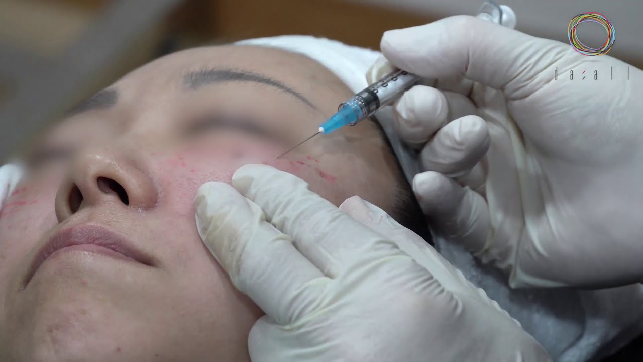 UNDER EYE WITH FILL 40MM || DAALL THREAD LIFT - YouTube