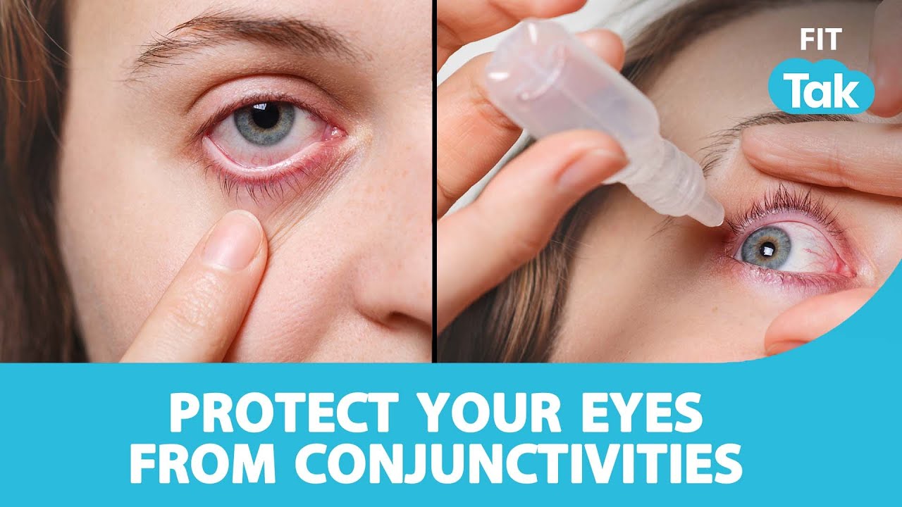 Protect Your Eyes From CONJUNCTIVITIES This Monsoon | Eye Infection ...